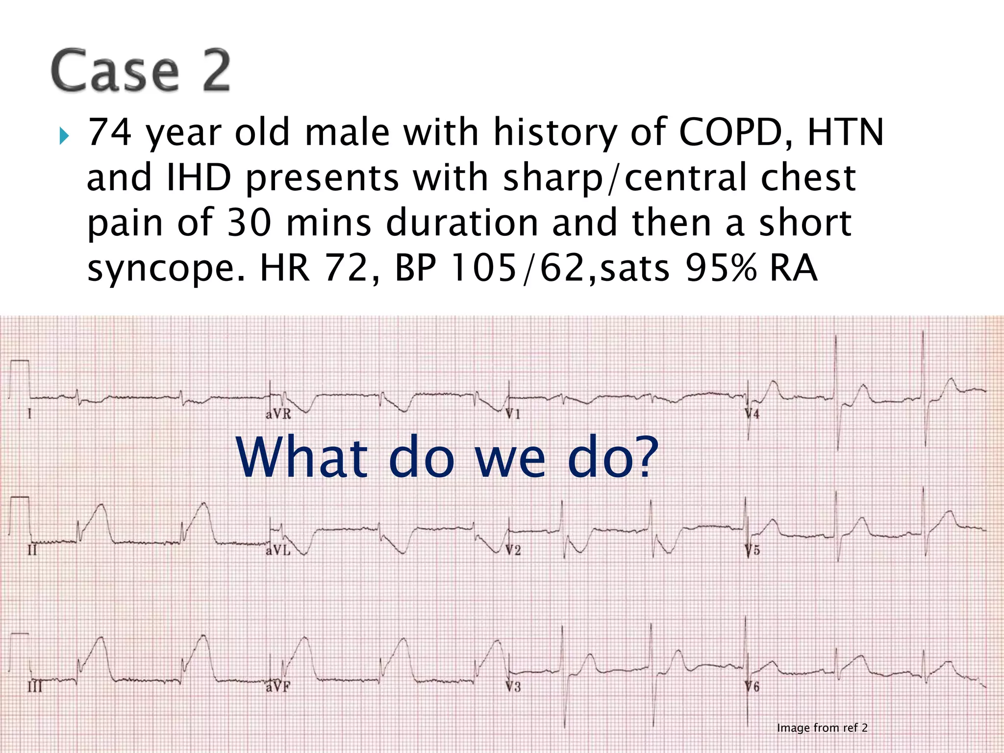 Syncope and the ECG | PPT