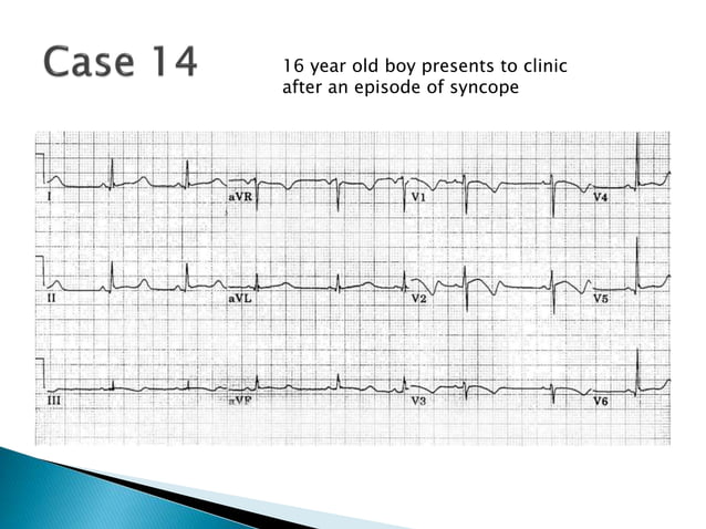 Syncope and the ECG | PPTX | Heart and Cardiovascular Diseases | Diseases and Conditions