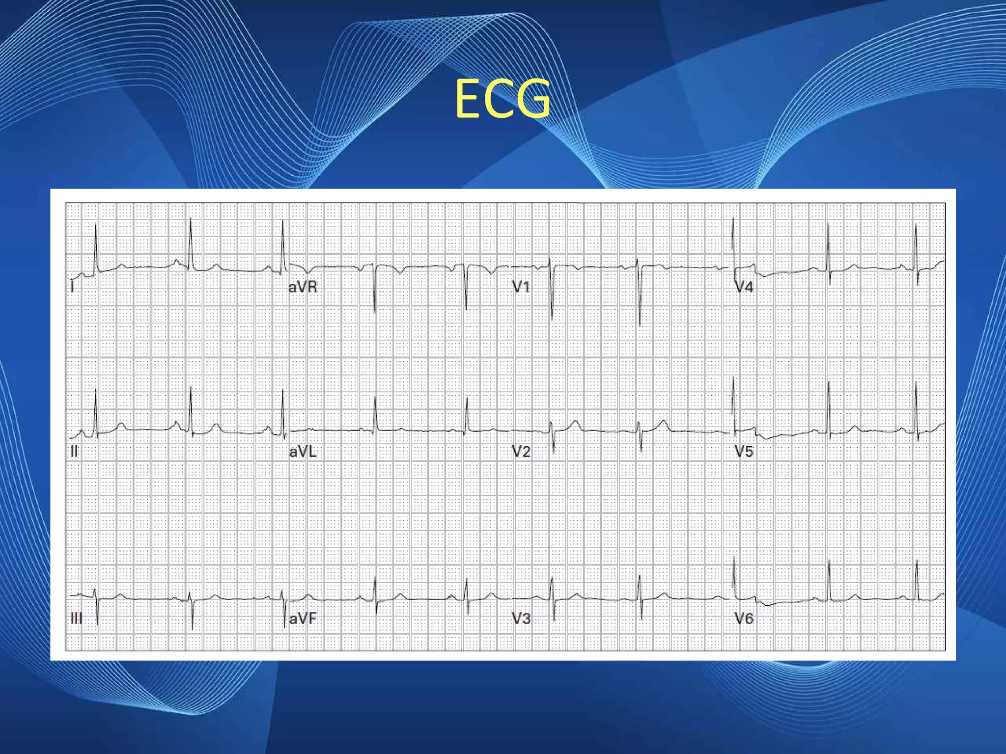 Approach to Syncope | PPT