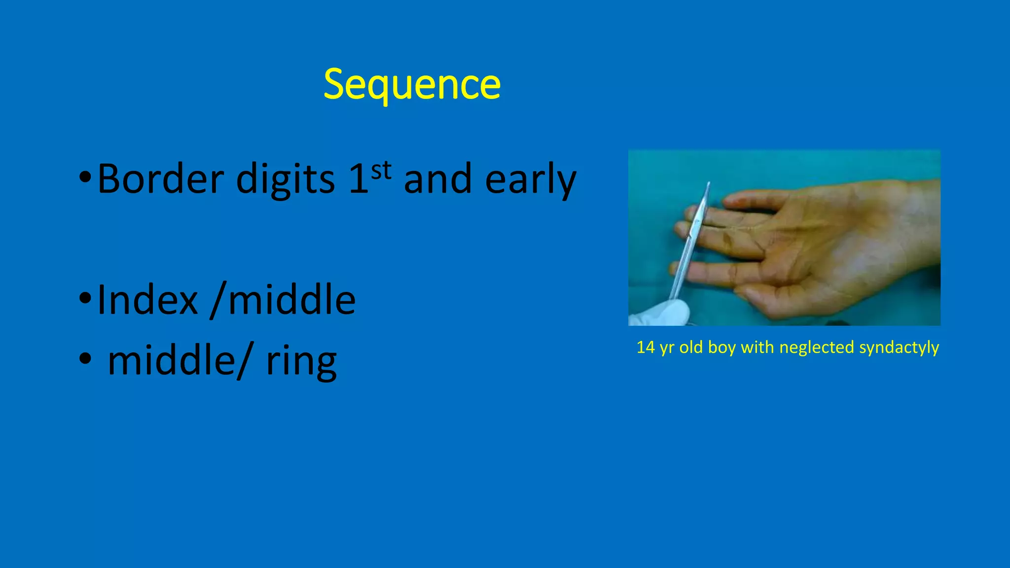 Syndactyly | PPTX