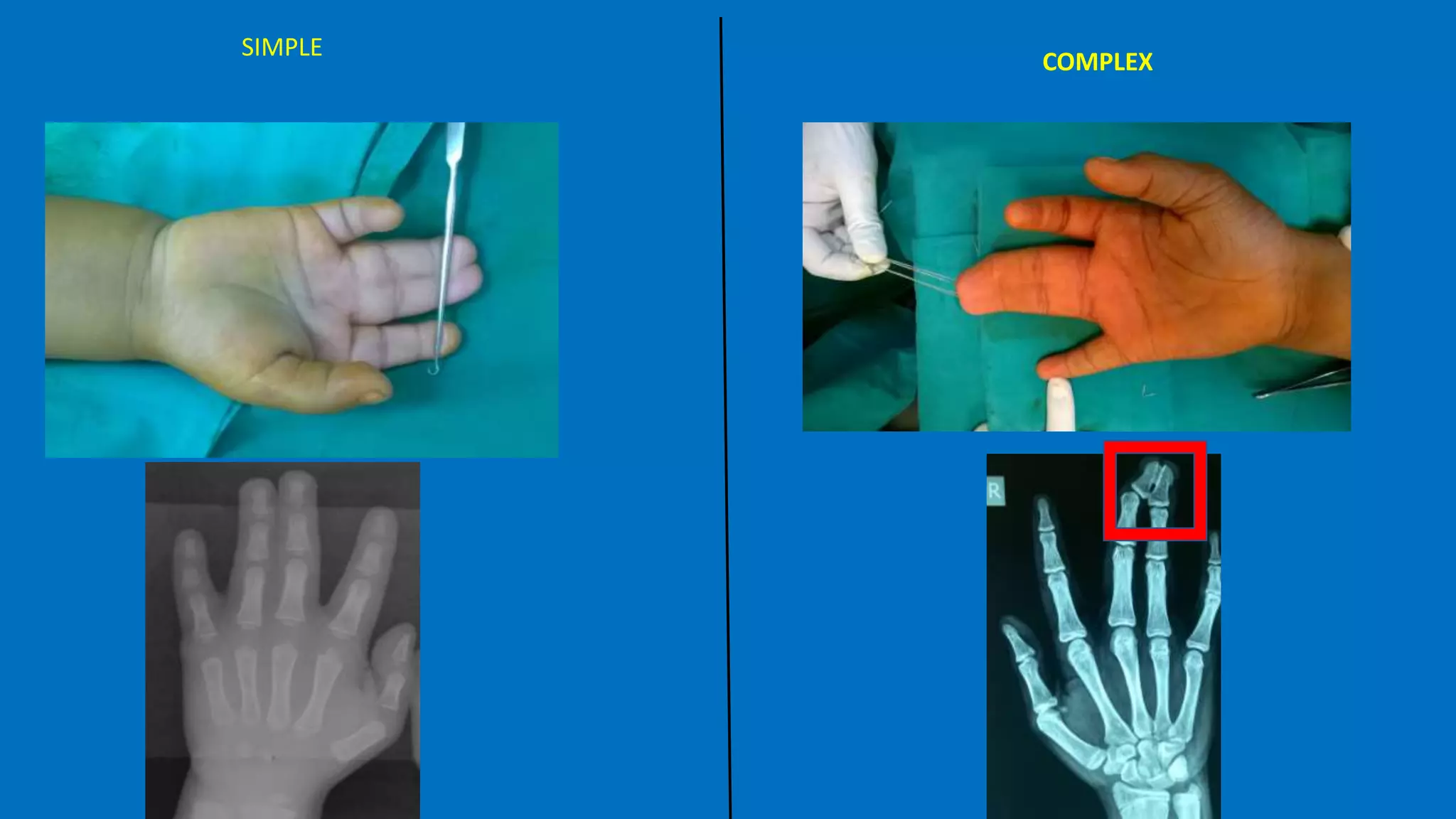 Syndactyly | PPTX