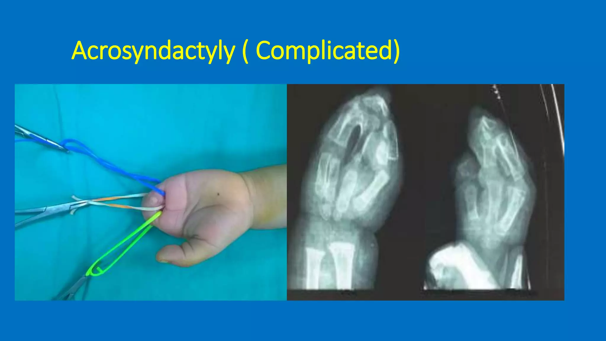 Syndactyly | PPTX