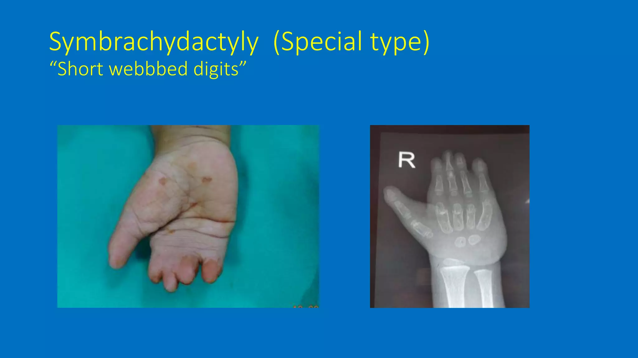 Syndactyly | PPTX