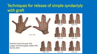 Syndactyly | PPTX