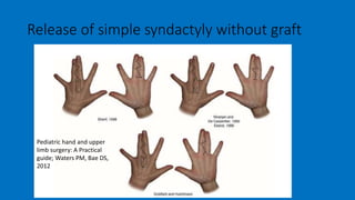 Syndactyly | PPTX