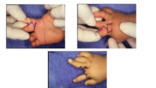 Syndactyly Hand | PPTX