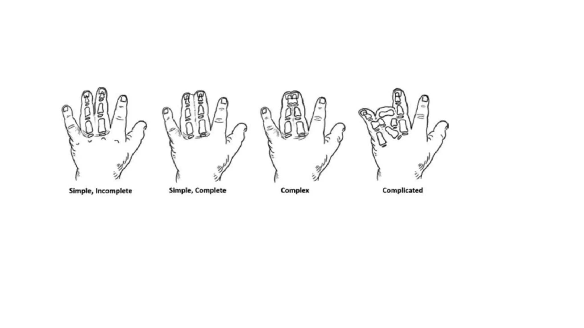 Syndactyly | PPTX