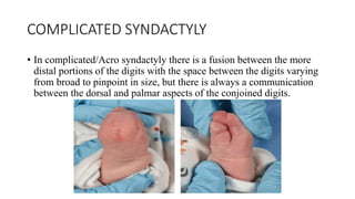 Syndactyly | PPTX