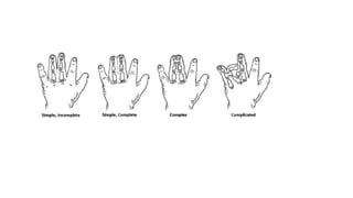 Syndactyly | PPTX