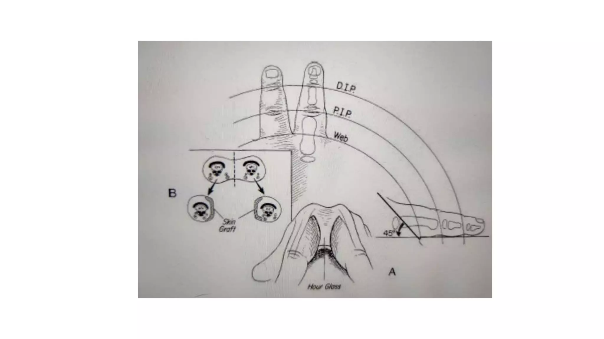 Syndactyly.pptx