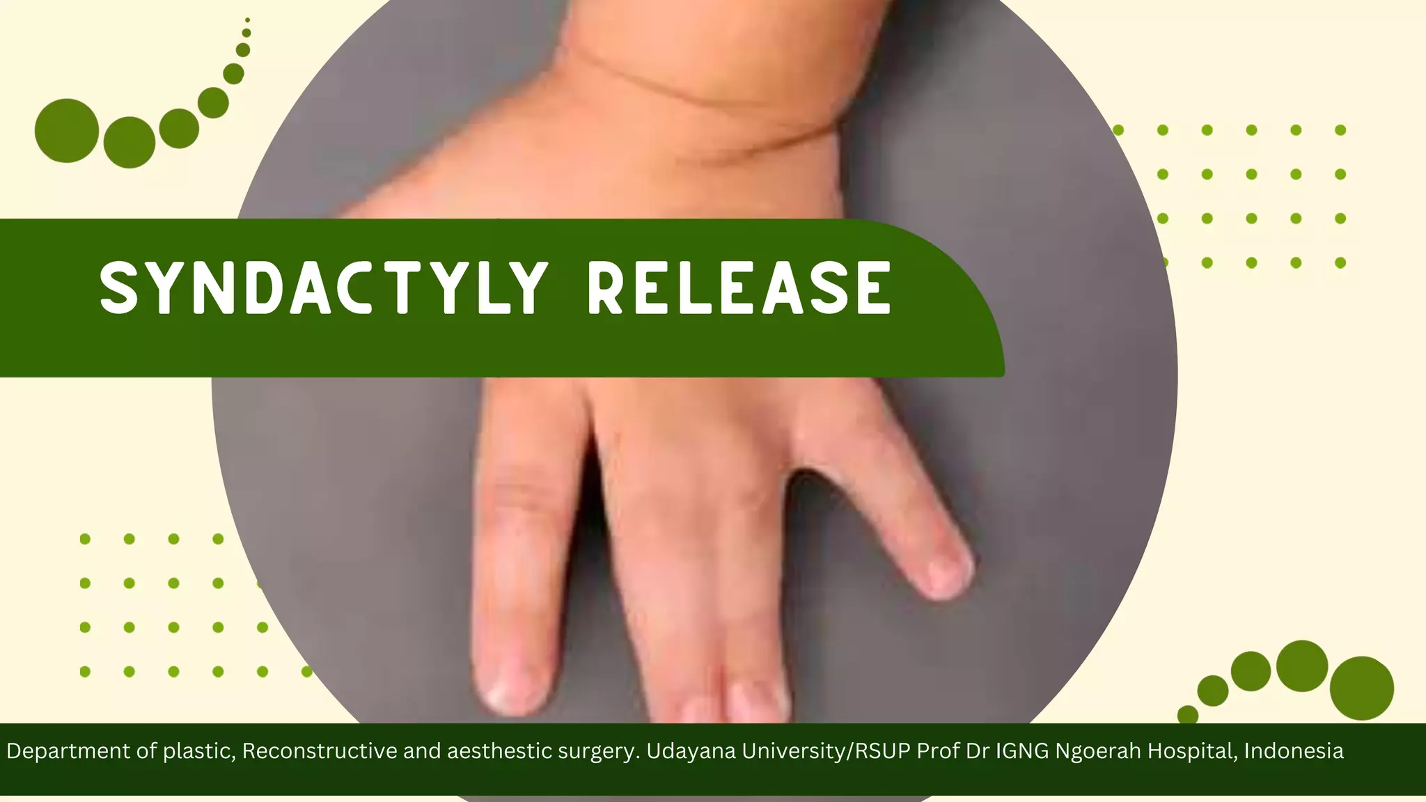 SYNDACTYLY RELEASE..pptx