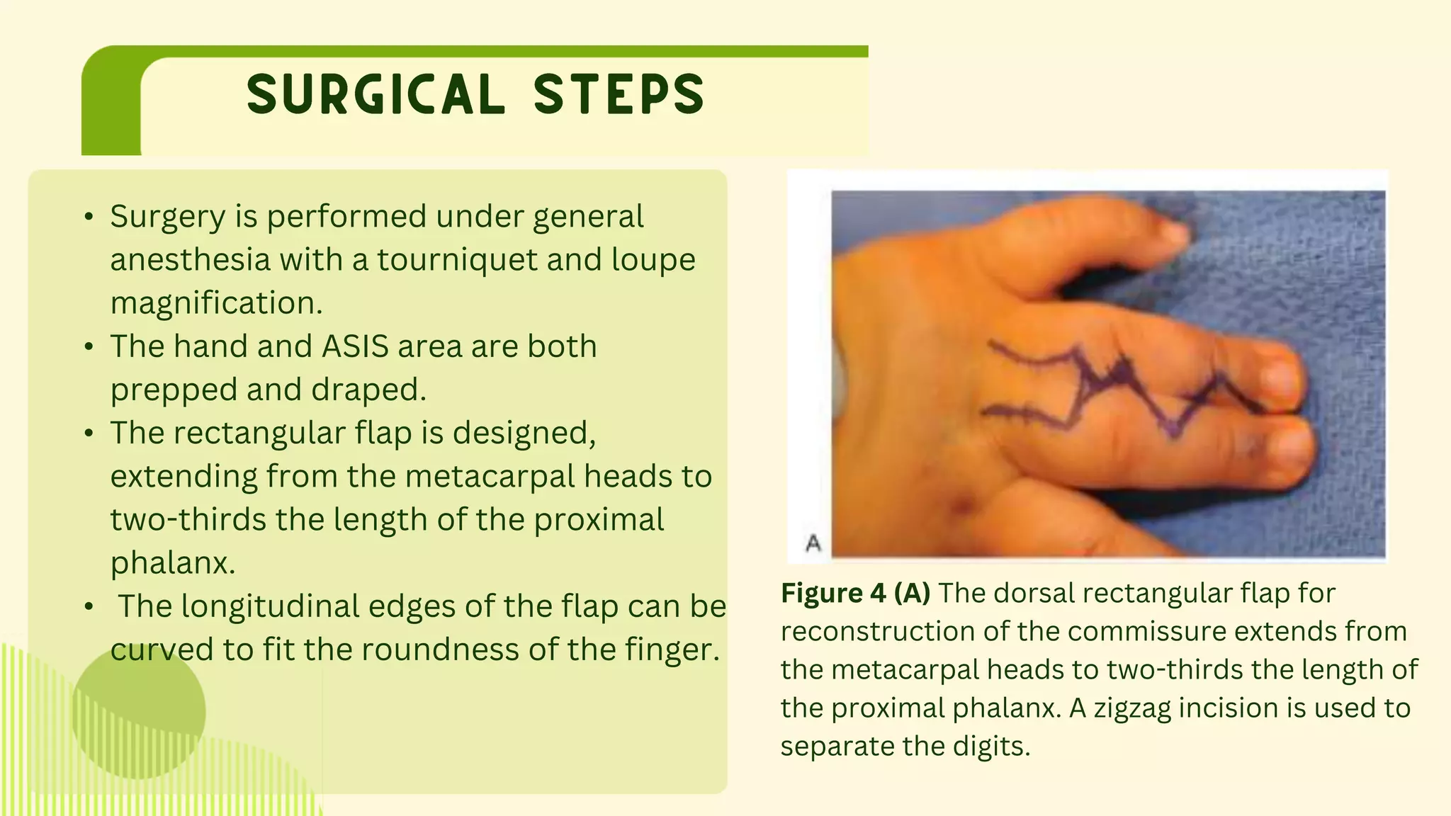 SYNDACTYLY RELEASE..pptx