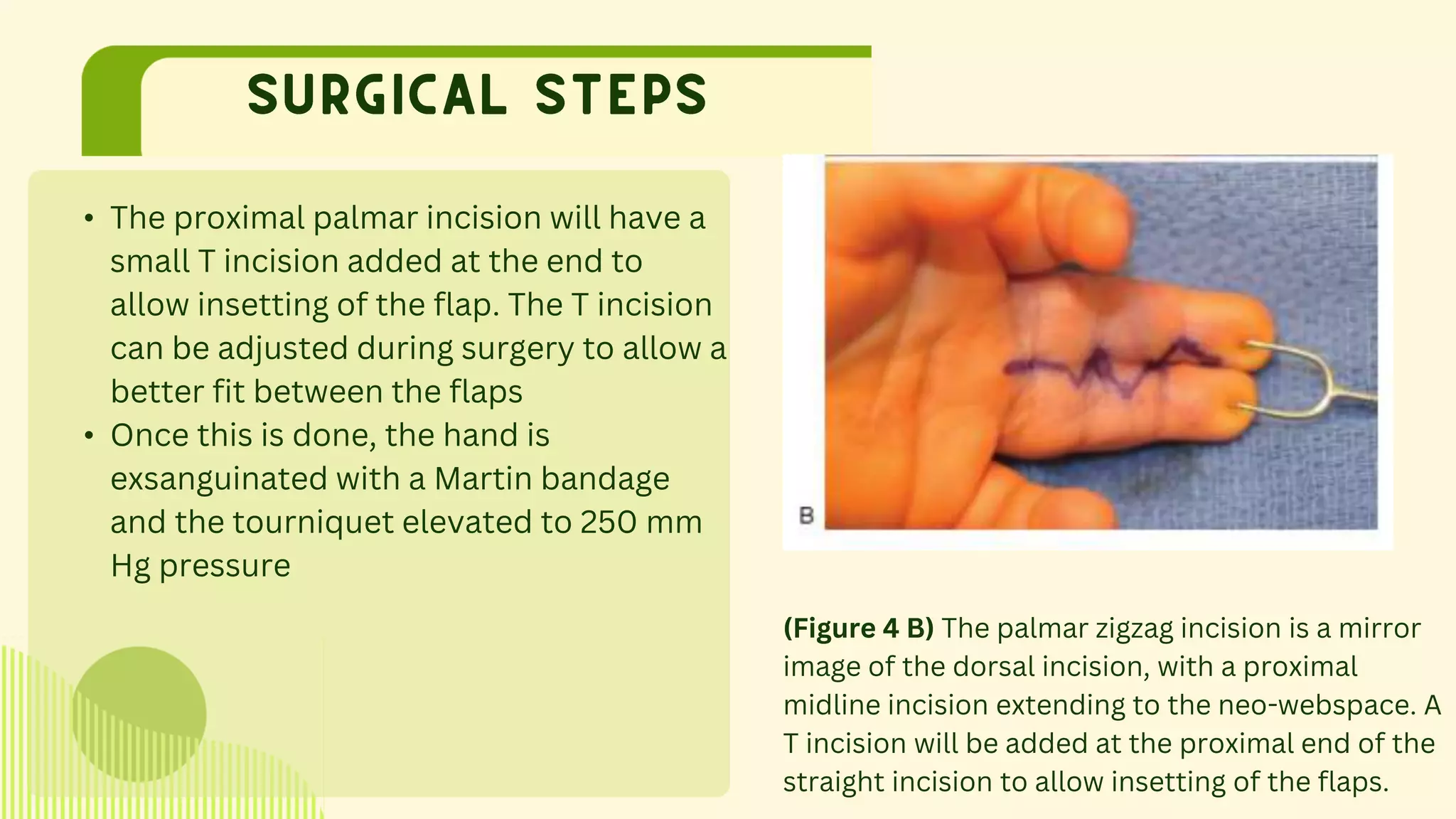 SYNDACTYLY RELEASE..pptx