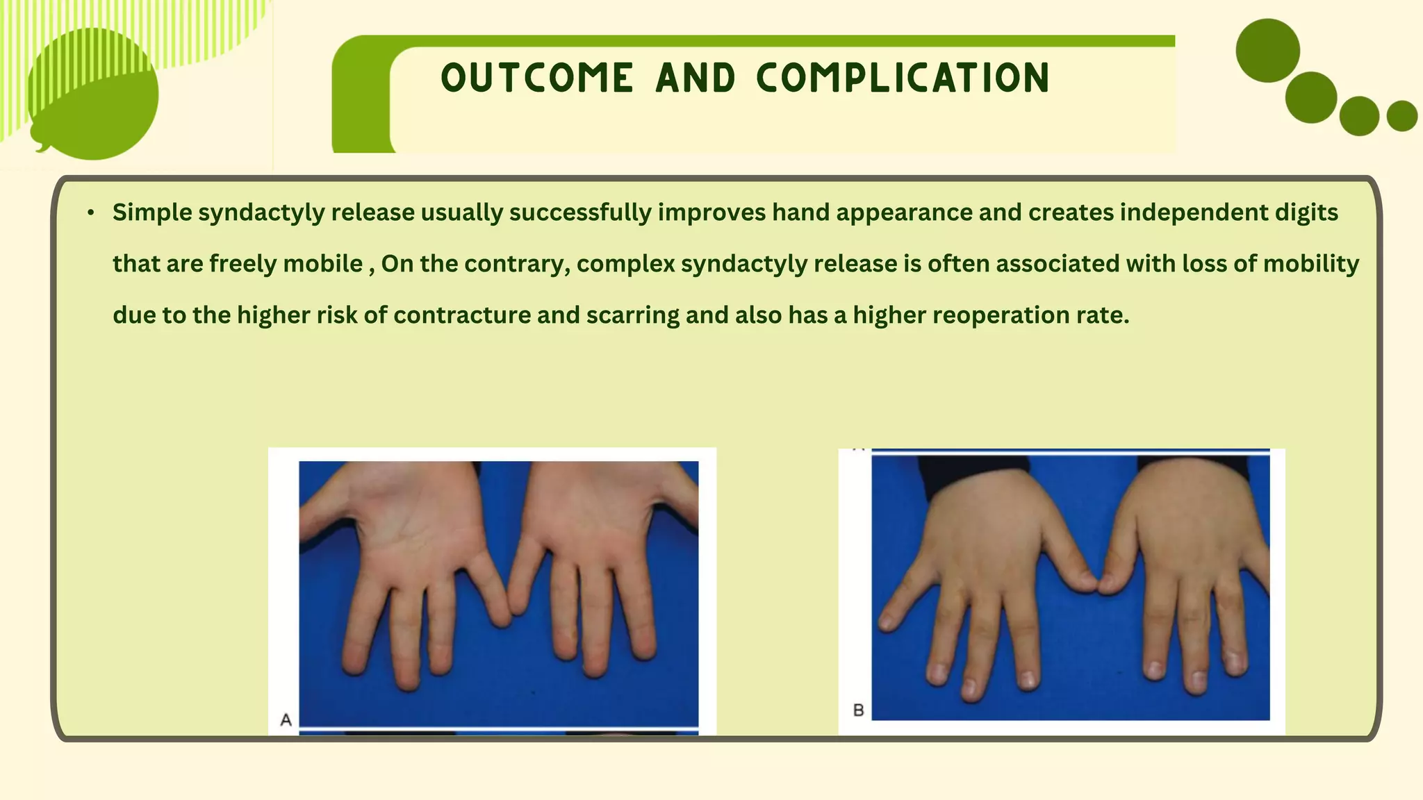 SYNDACTYLY RELEASE..pptx