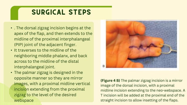 SYNDACTYLY RELEASE..pptx