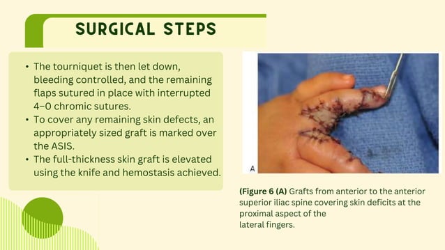 SYNDACTYLY RELEASE..pptx