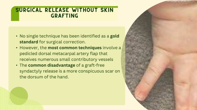 SYNDACTYLY RELEASE..pptx