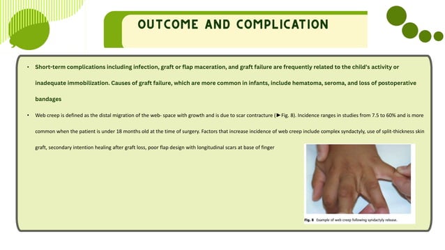 SYNDACTYLY RELEASE..pptx