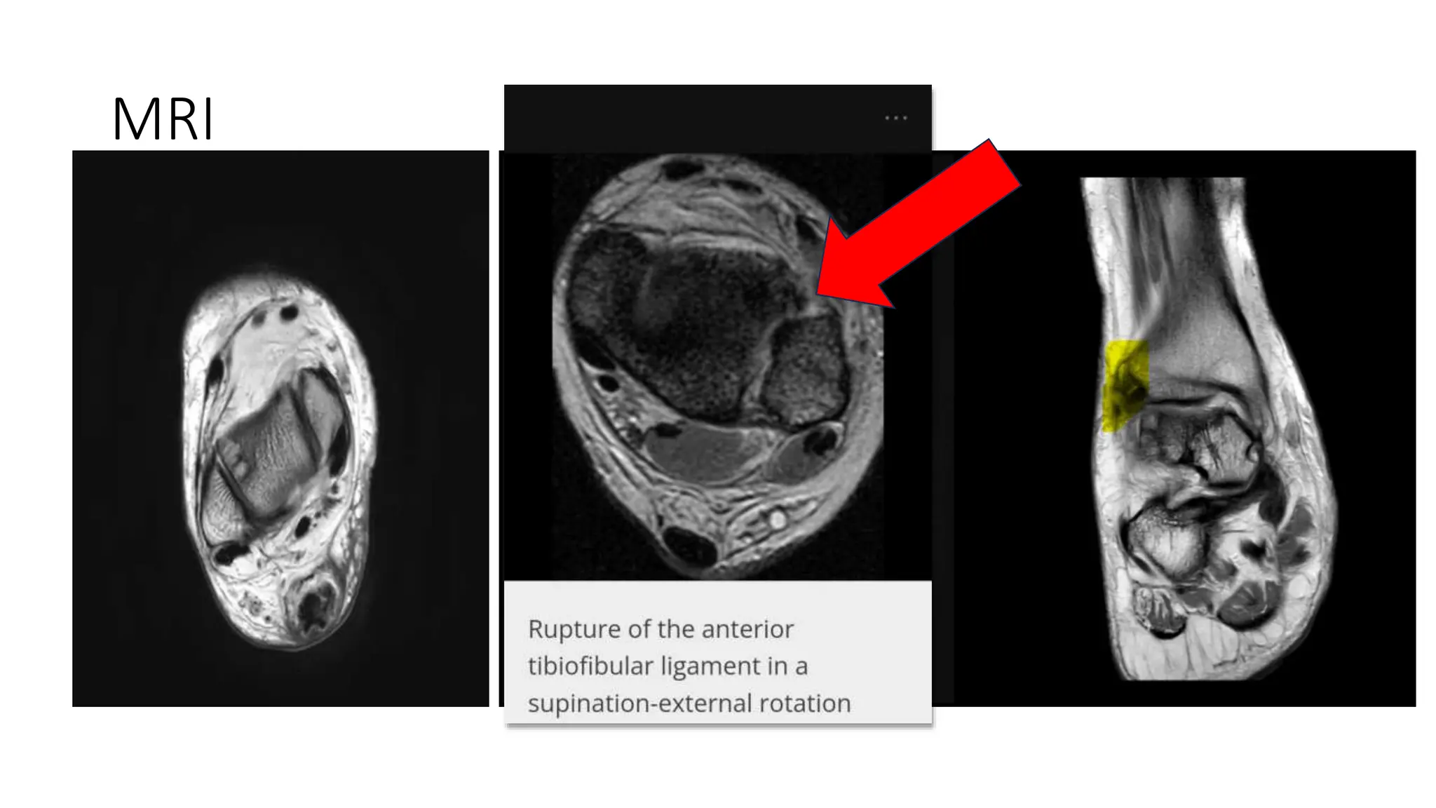 SYNDESMOTIC INJURY- ANATOMICAL REPAIR.pptx