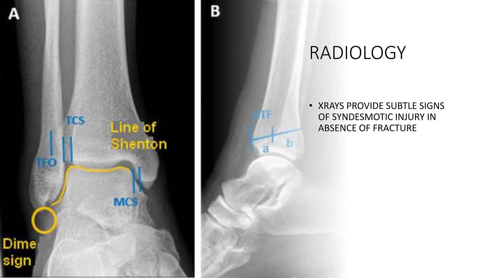 SYNDESMOTIC INJURY- ANATOMICAL REPAIR.pptx