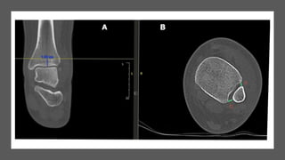 SYNDESMOTIC INJURY- ANATOMICAL REPAIR.pptx
