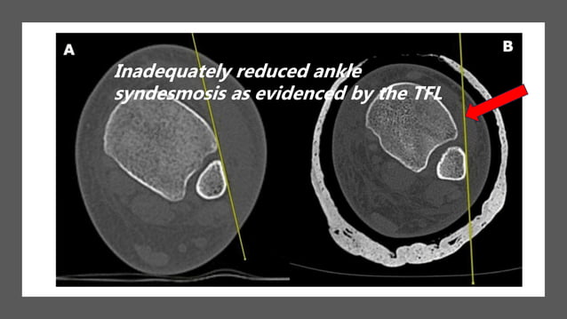 SYNDESMOTIC INJURY- ANATOMICAL REPAIR.pptx