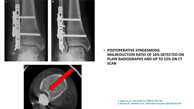 SYNDESMOTIC INJURY- ANATOMICAL REPAIR.pptx