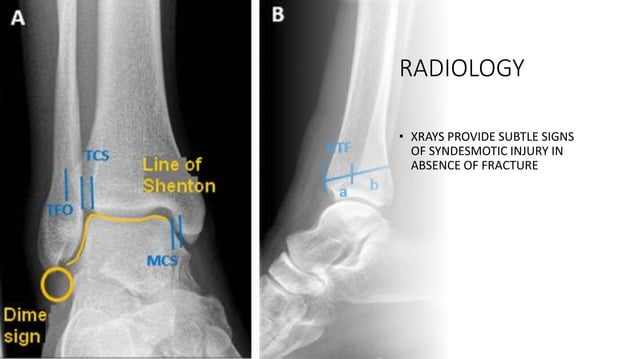 SYNDESMOTIC INJURY- ANATOMICAL REPAIR.pptx