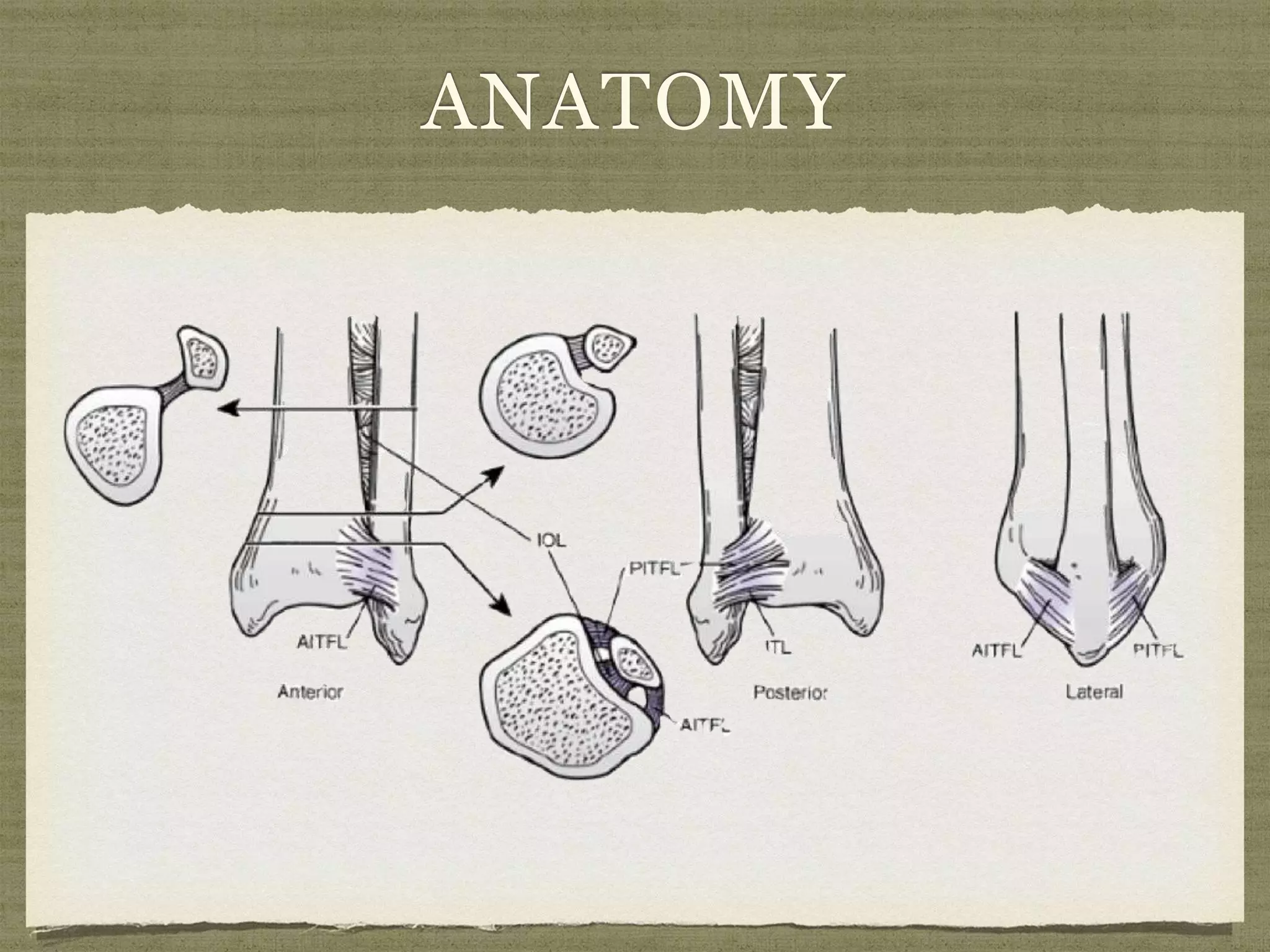 syndesmotic injury mechanism and treatment subject review | PPTX