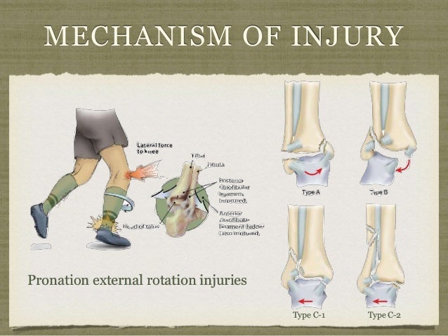 High Ankle Sprain Mechanism
