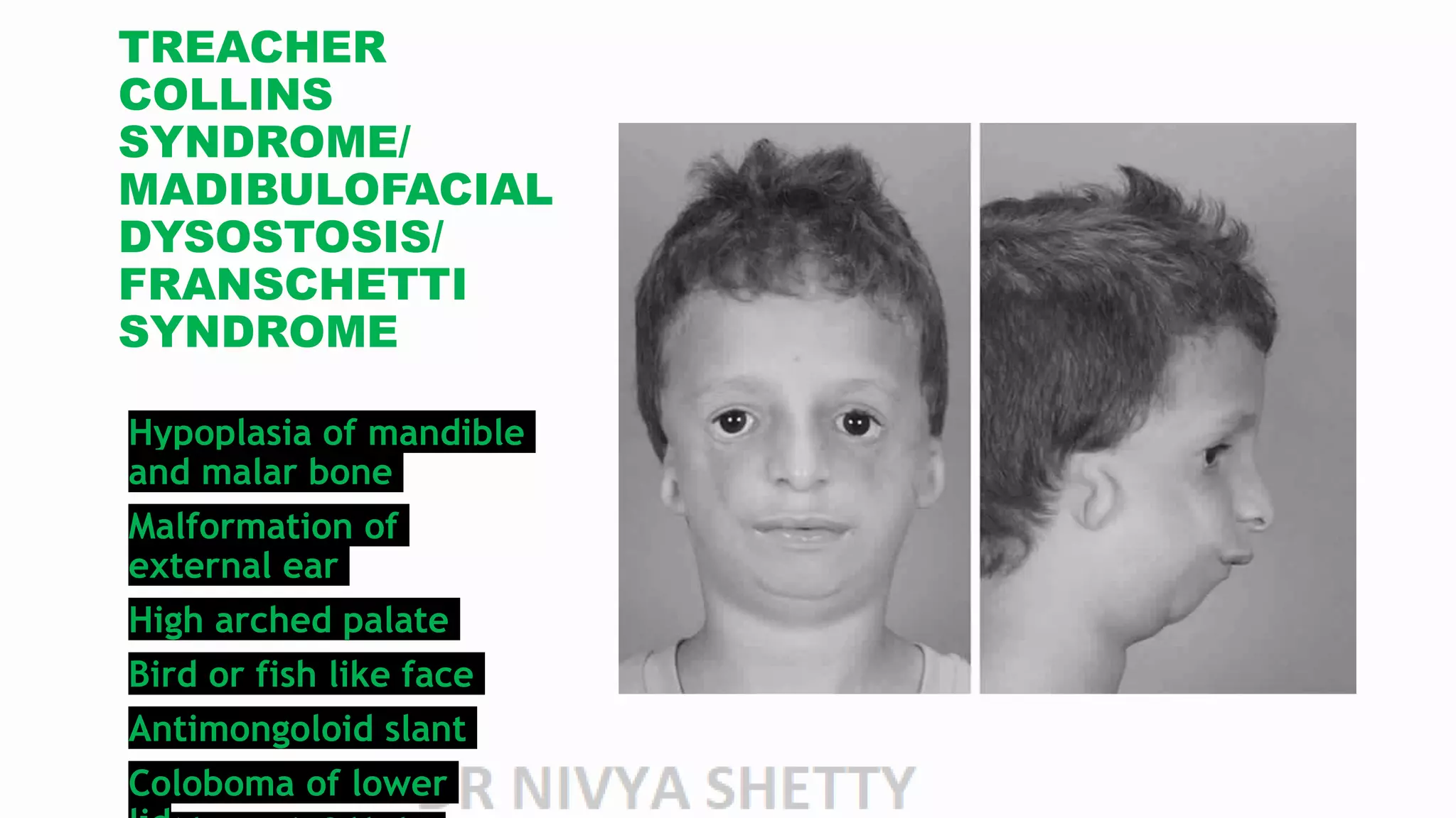 Syndromes of head neck face | PPTX