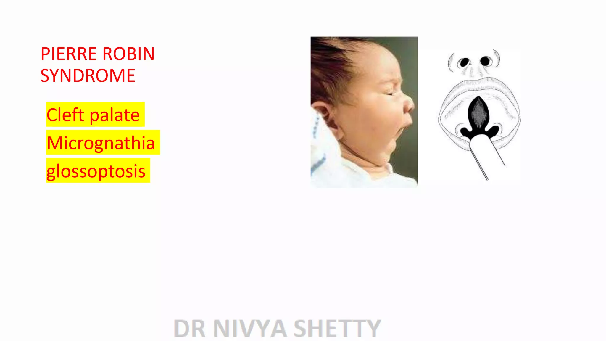 Syndromes of head neck face | PPTX