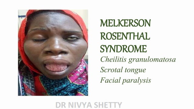 Syndromes of head neck face | PPTX | Dental Health | Diseases and ...