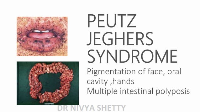Syndromes of head neck face | PPTX | Dental Health | Diseases and ...