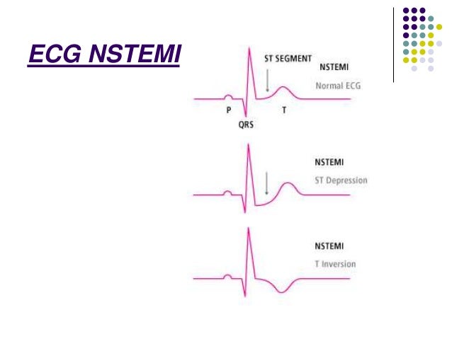 Quelle Est La Différence Entre Un Stemi Et Une Attaque Cardiaque – KMFLVO