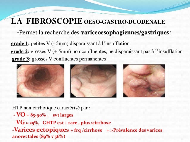 Syndrome htp non cirrhotique