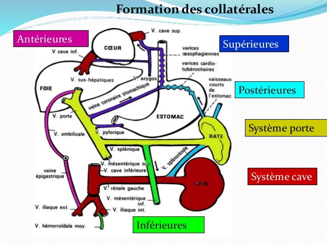 Syndrome htp non cirrhotique