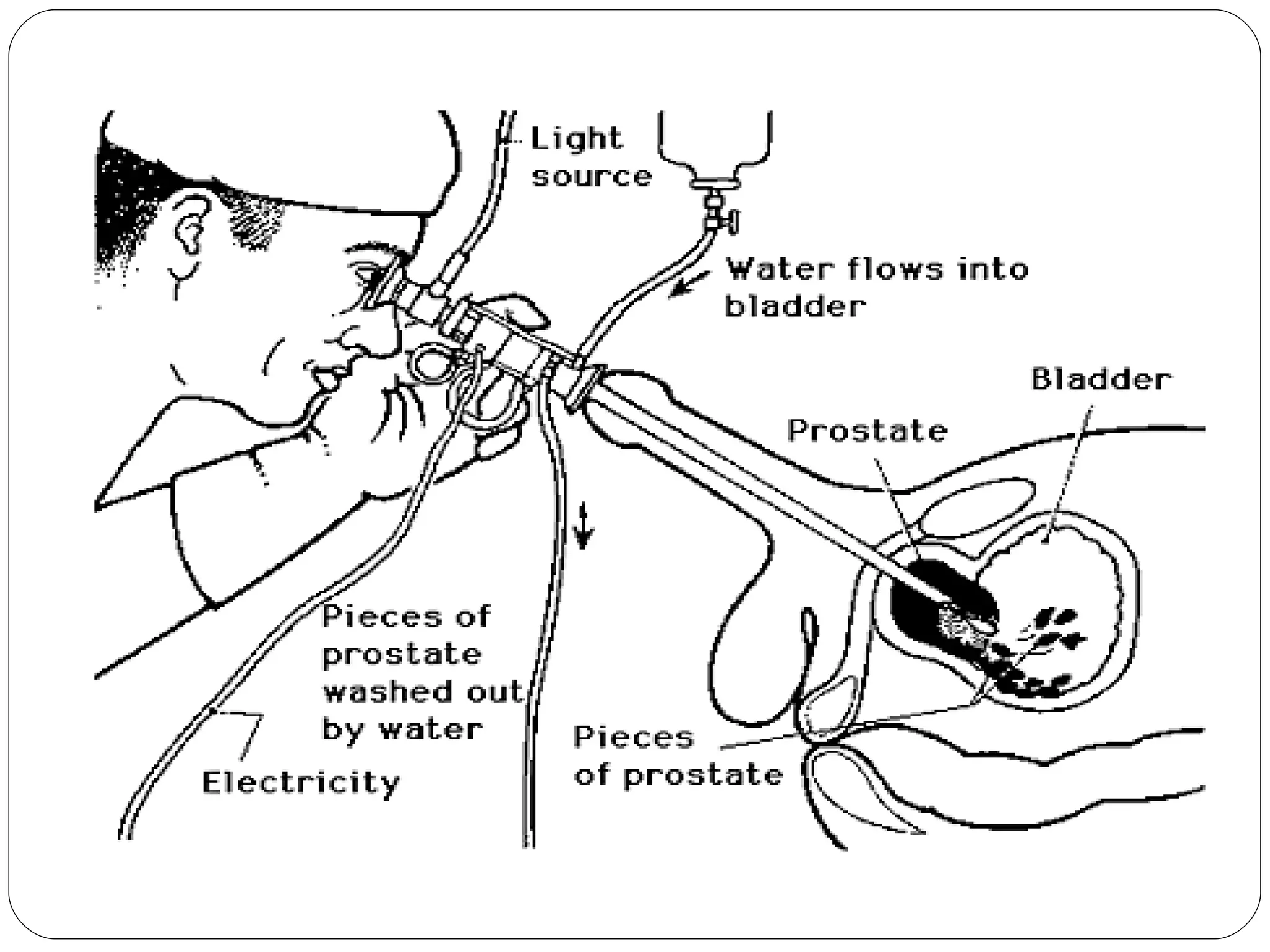Syndrome resection transuretral (tur syndrom) | PPT