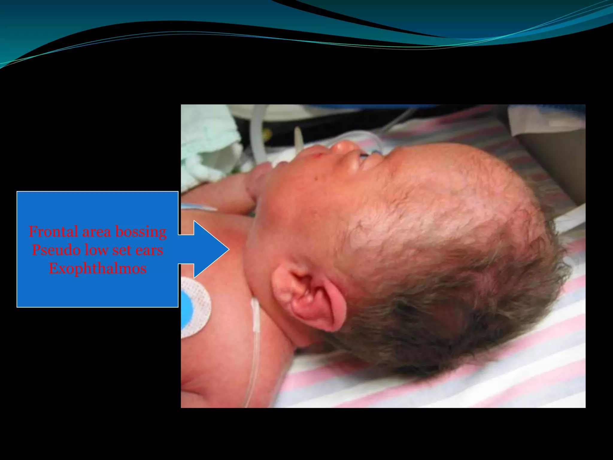 Syndromes of Head & Neck | PPTX