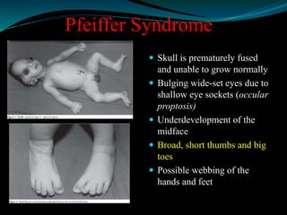 Pfeiffer Syndrome Hands And Feet