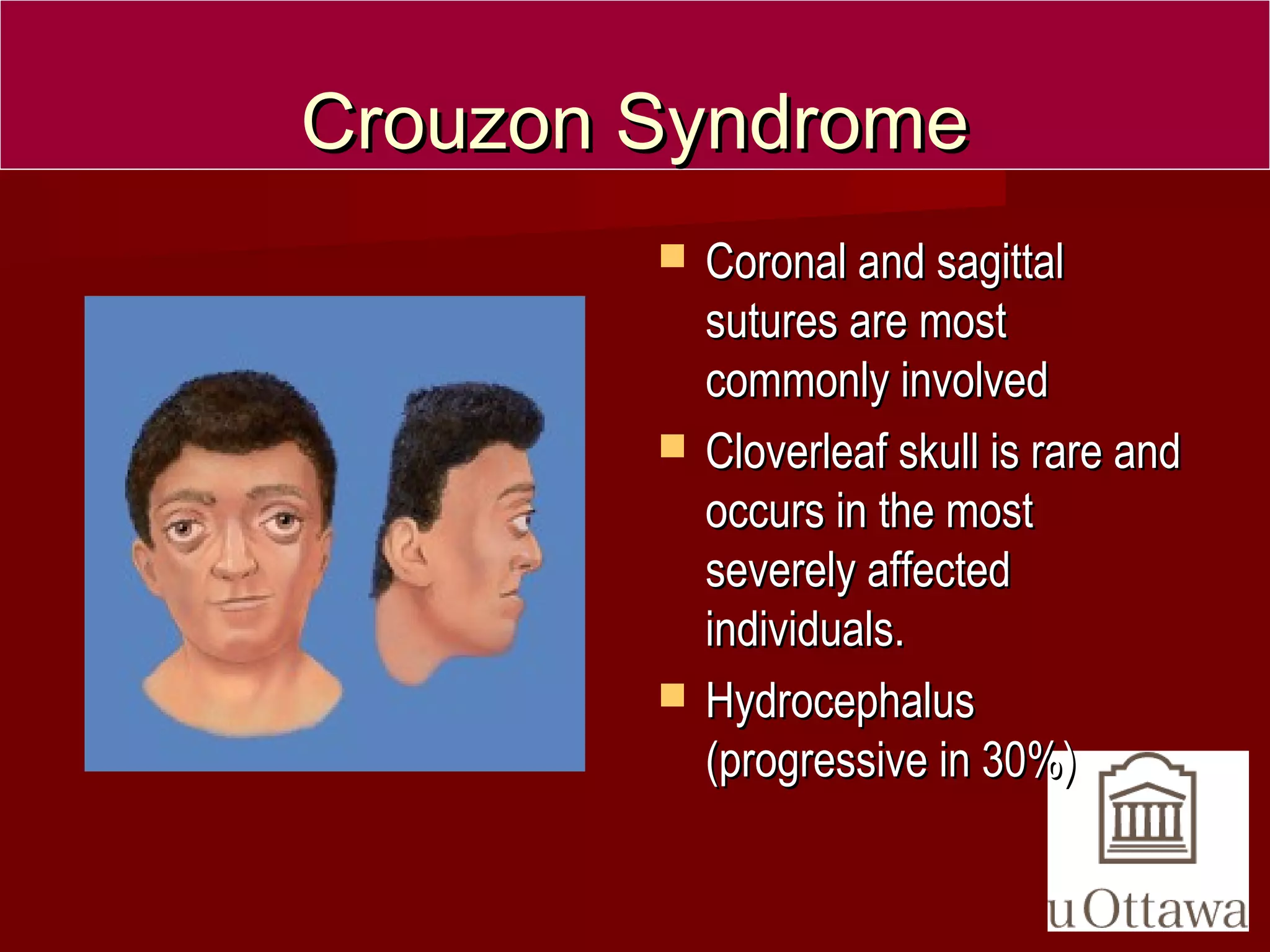 Syndromes | PPT