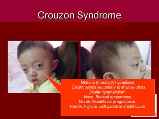Syndromes | PPT