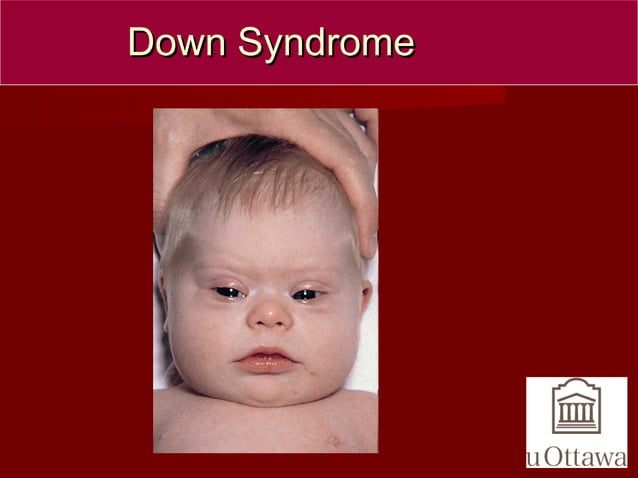 Syndromes | PPT