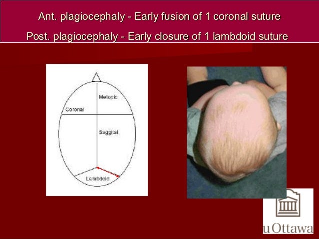 Lambdoid Suture