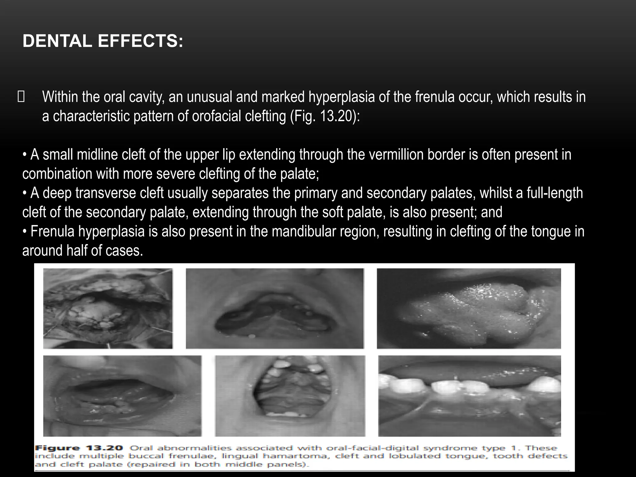 Syndromes affecting the craniofacial region.pdf