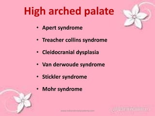 High Arched Palate