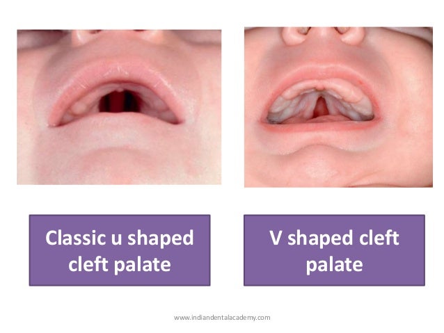Syndromes affecting the palate/ dental implant courses
