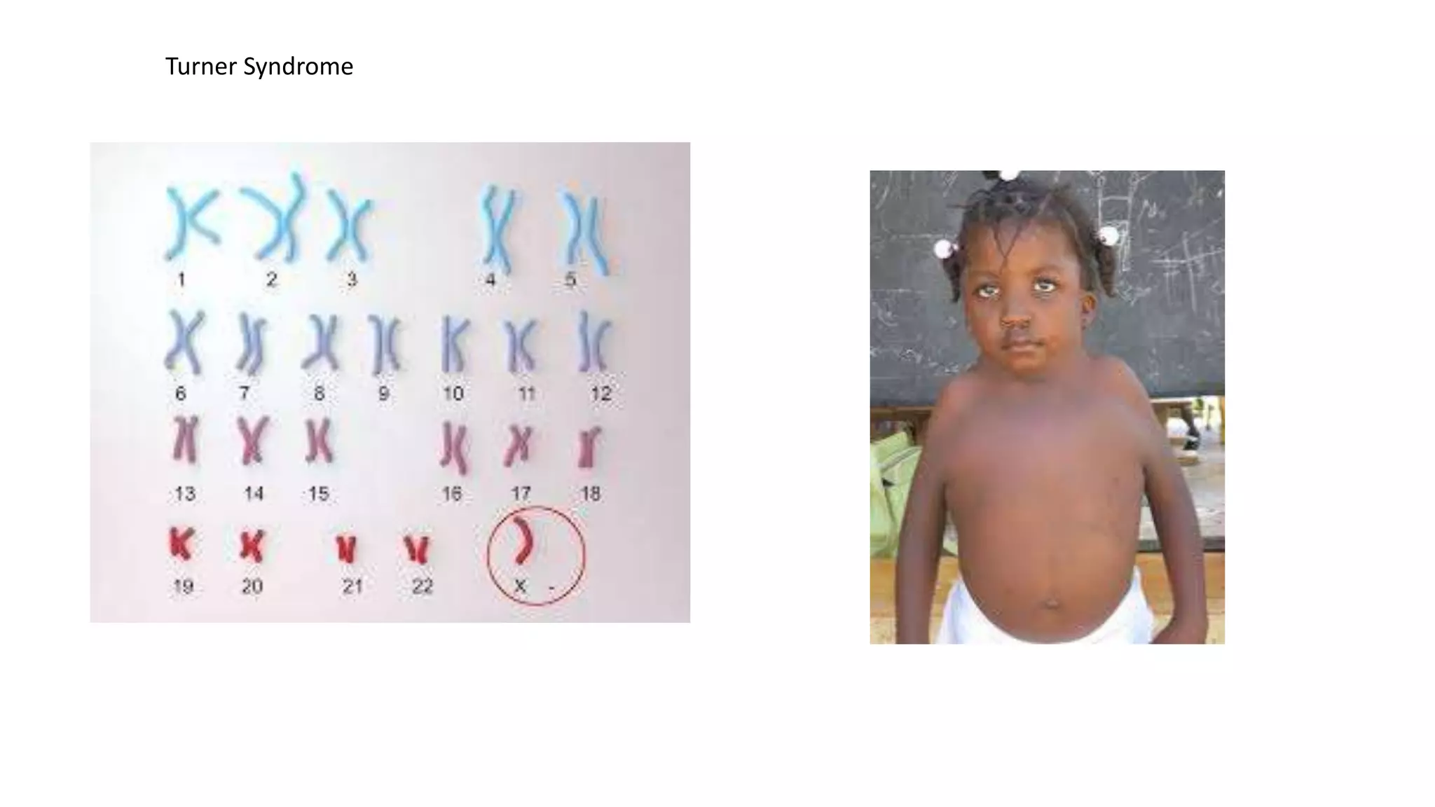 syndromes of humans.pptx