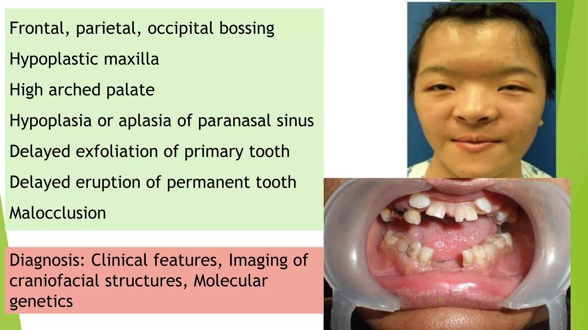 Syndromes of orofacial region mine | PPTX
