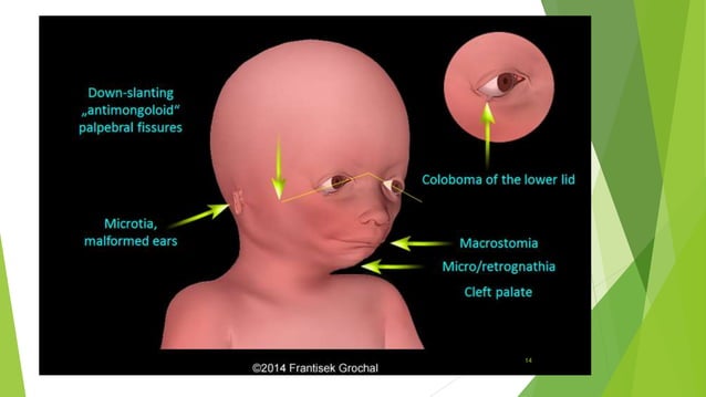 Syndromes of orofacial region mine | PPTX | Ear, Nose and Throat ...